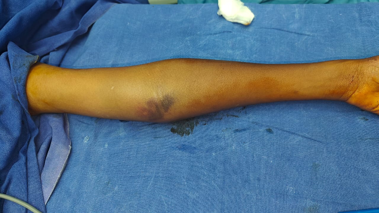 Fracture Left Humerus with DNVD - Adarsha Hospitals